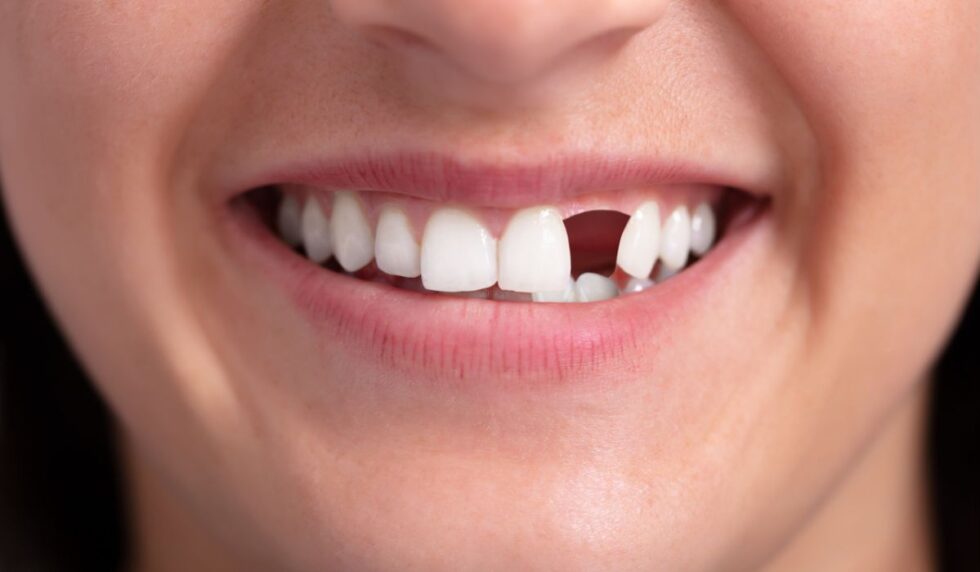 Should I replace a missing tooth? - Mosman Dental Surgery | MOSMAN